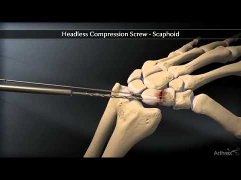 Arthrex Headless Compression Screw – Scaphoid - YouTube