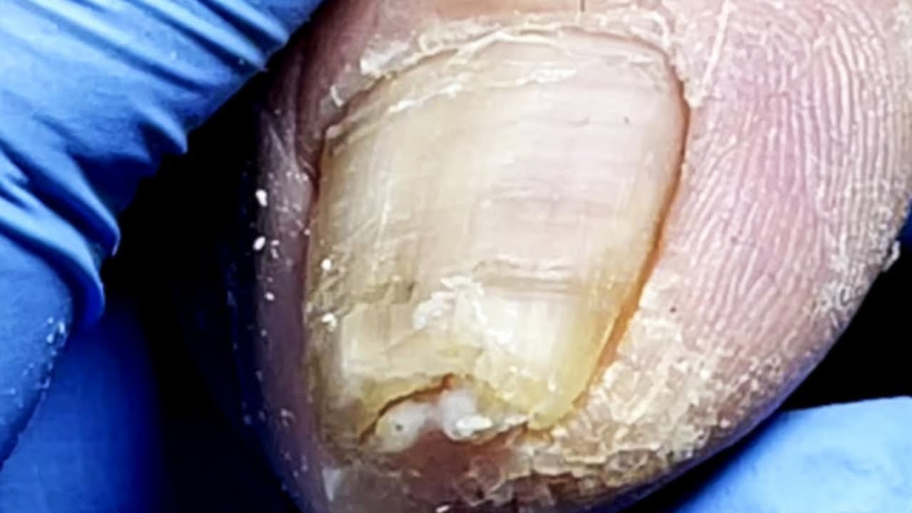 Trimmed two ingrown toenails and removed dead skin - YouTube