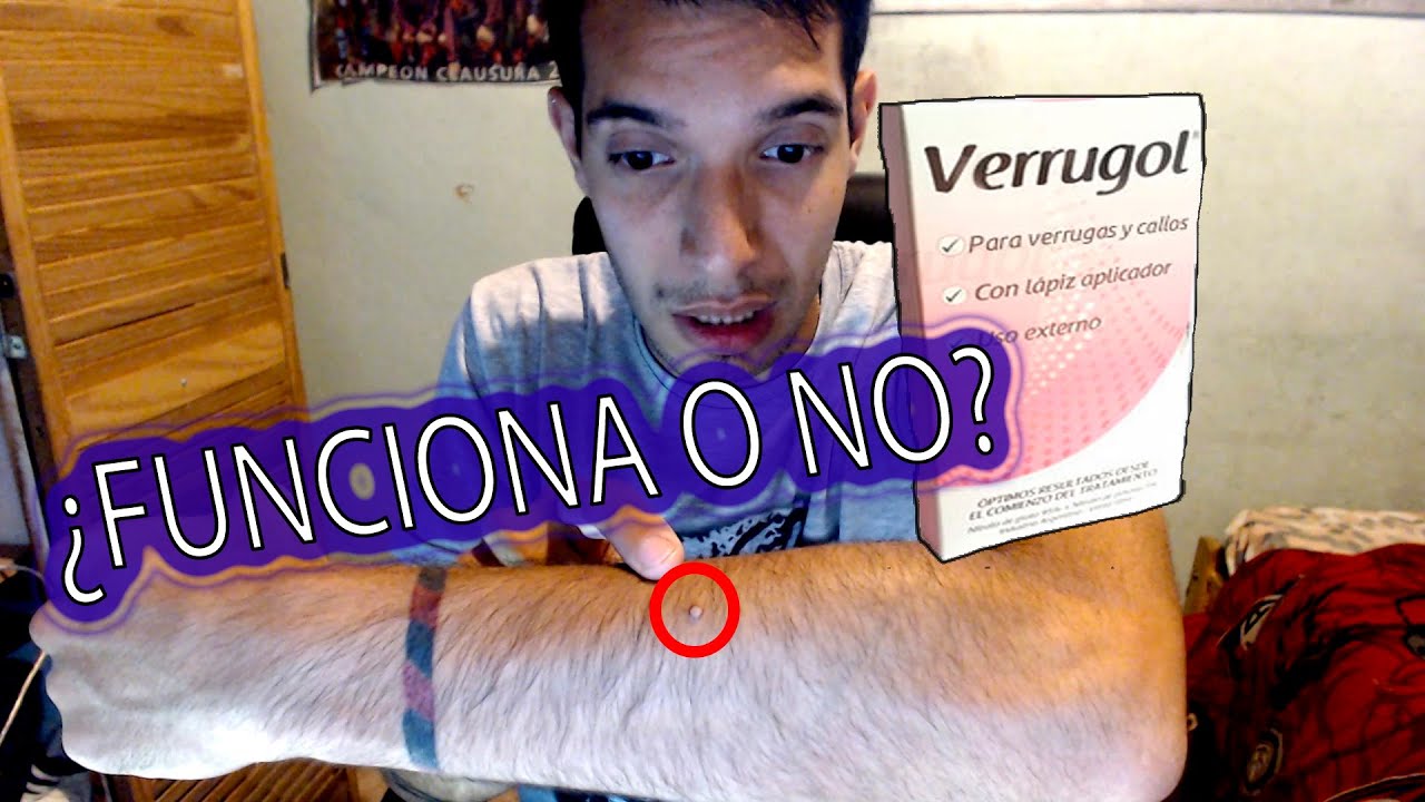¿Funciona Verrugol? ¿La recomiendo? - Te dejo mi experiencia ! - YouTube