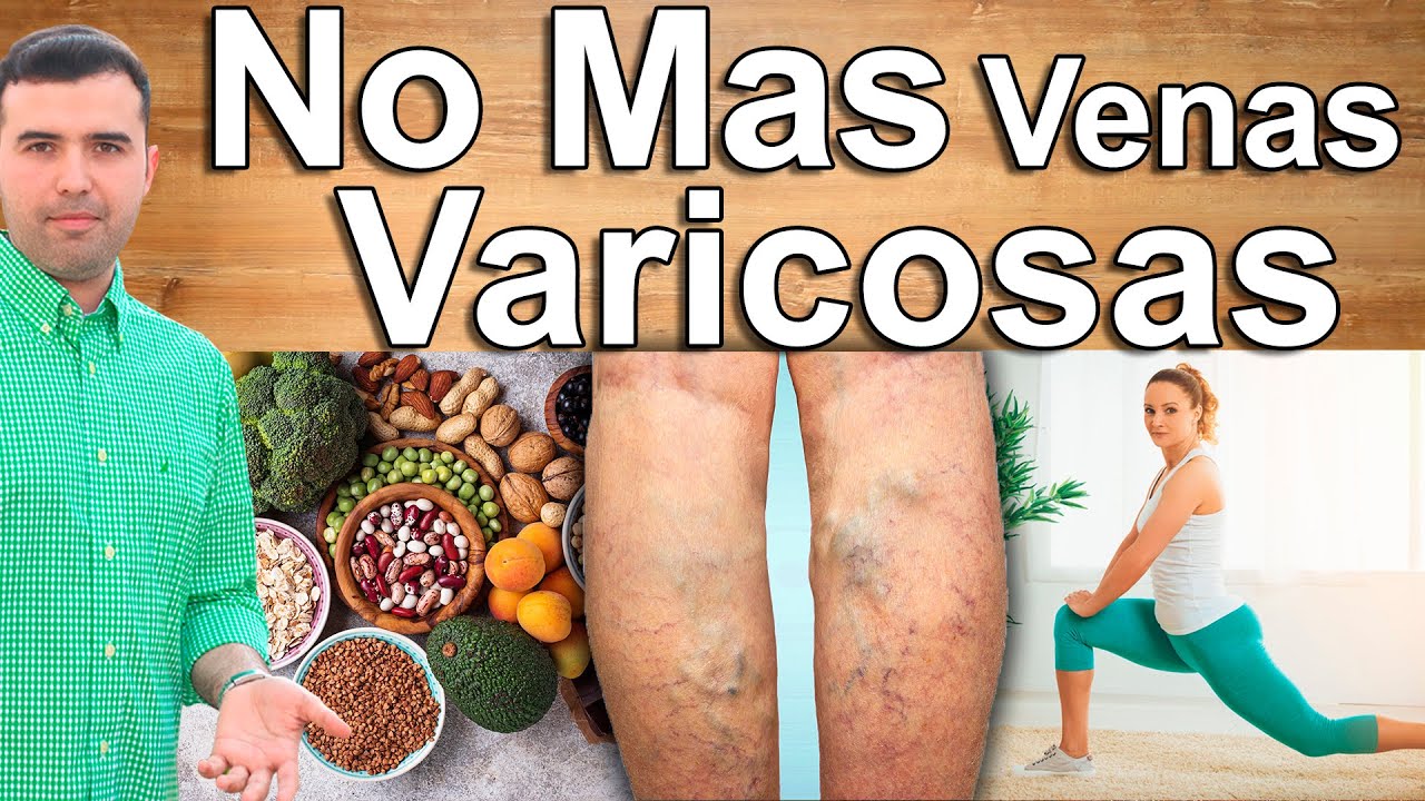 ADIÓS A LAS VARICES - Tratamientos Naturales Para las Varices en las ...