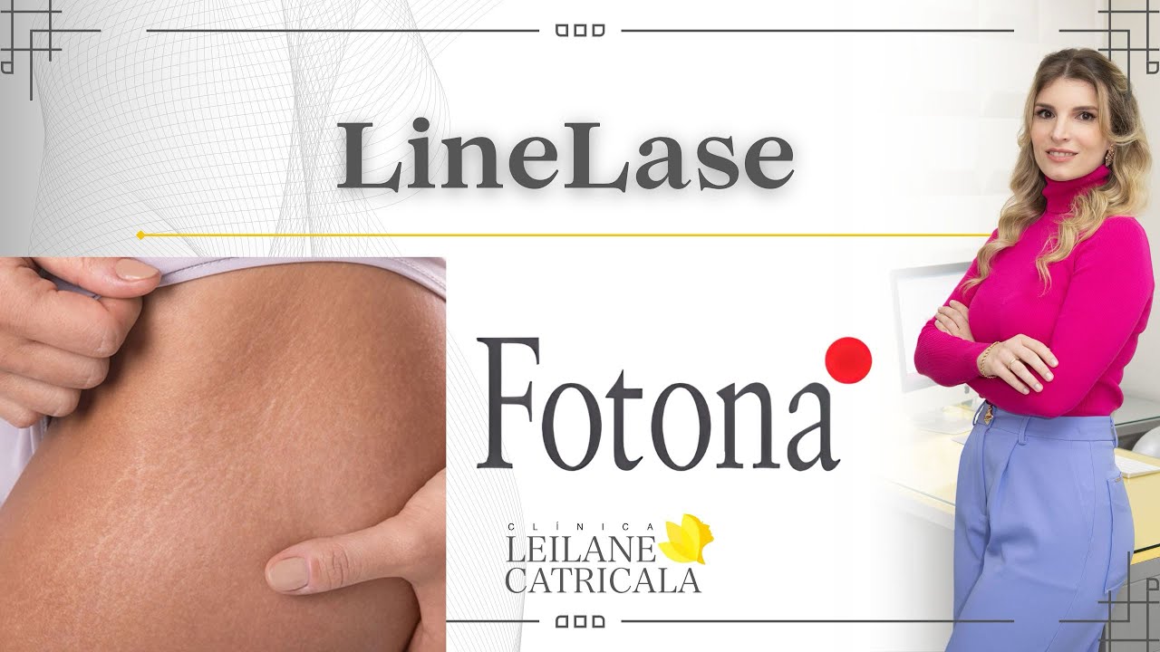 Tratamento para estrias com o Laser Fotona - YouTube