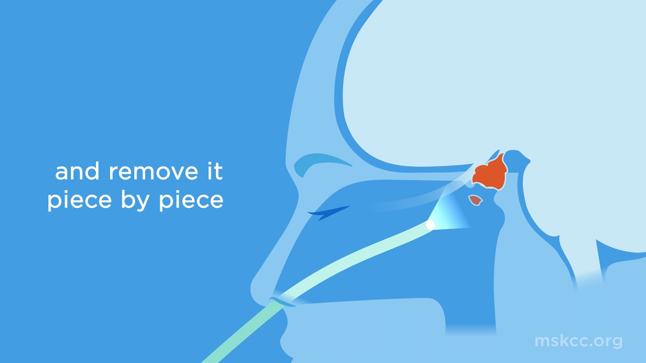 About Your Transsphenoidal Surgery - YouTube