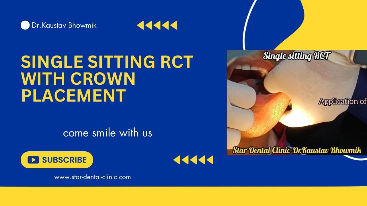 How to do single sitting rct with crown placement? - YouTube