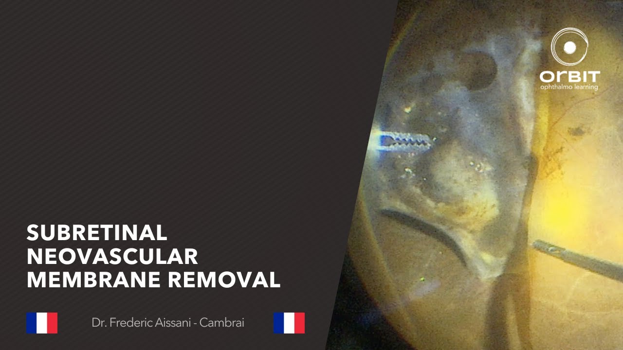 Subretinal Neovascular Membrane Removal - YouTube
