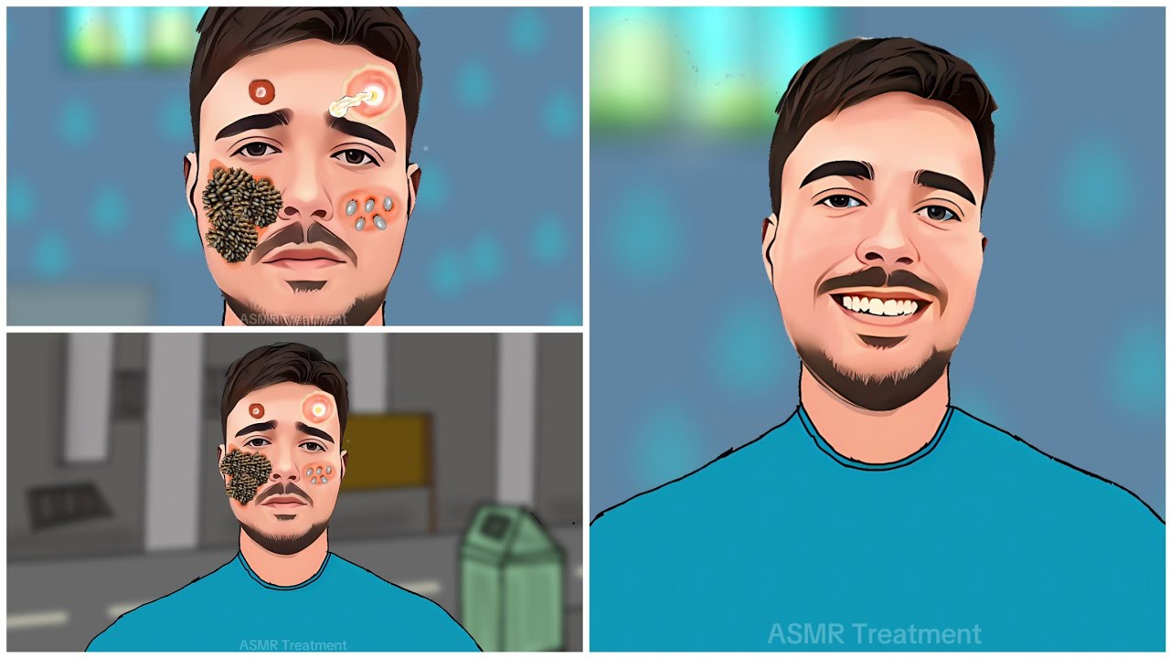 ASMR Treatment Animation relex treatment video Mr beast treatment ...