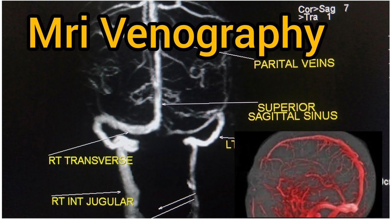 Mri Venography Brain Fillming Easy Technique in Hindi #mriVenogram # ...