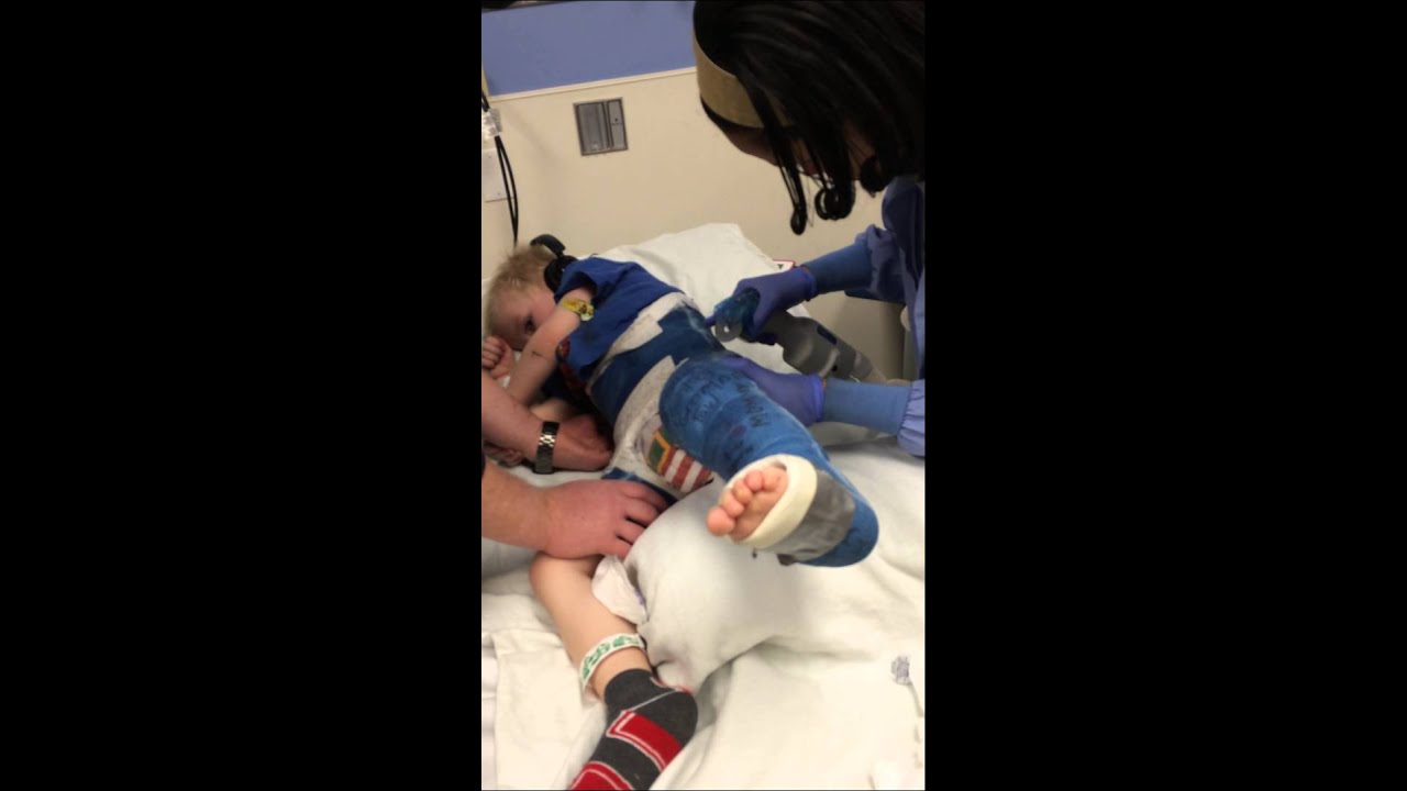 Cast Removal - YouTube