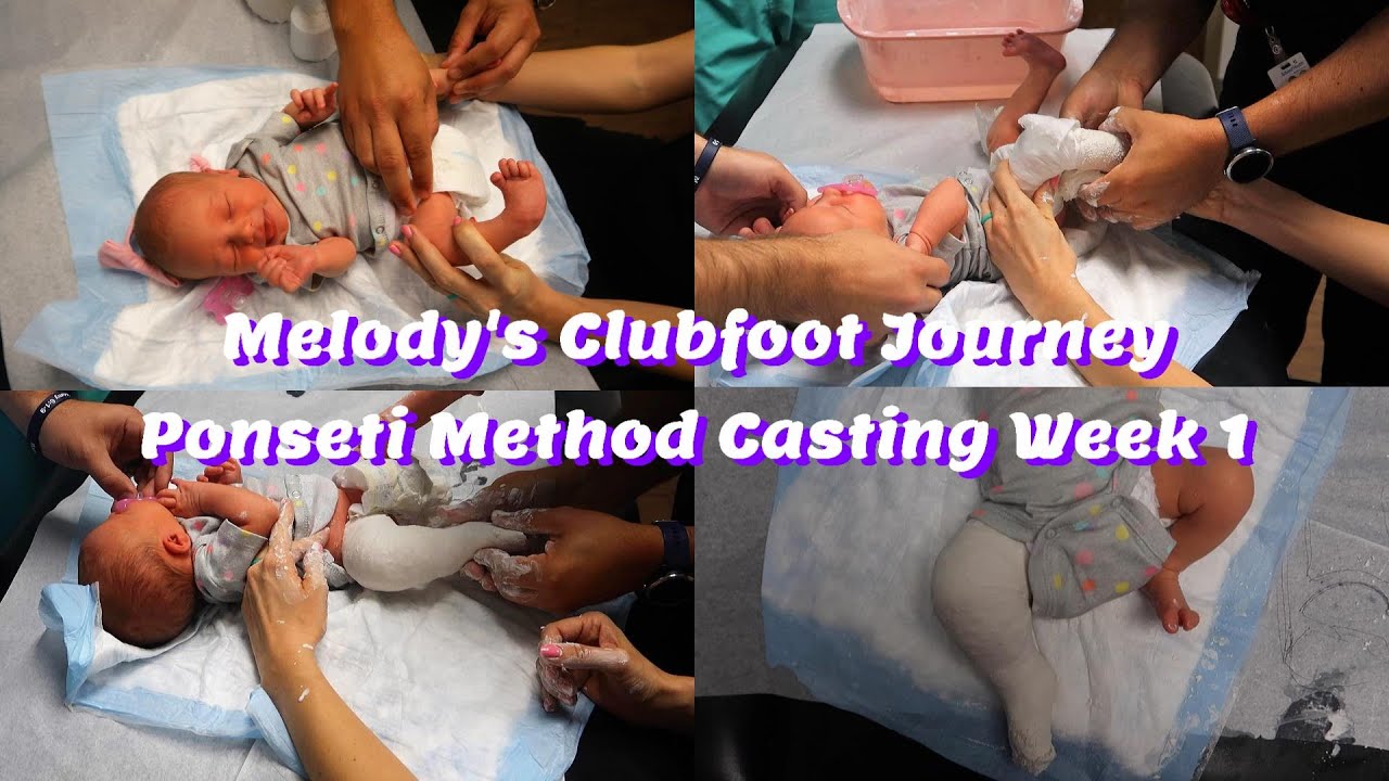 Cast #1 Melody's Clubfoot Treatment Journey- Ponseti Method Casting ...