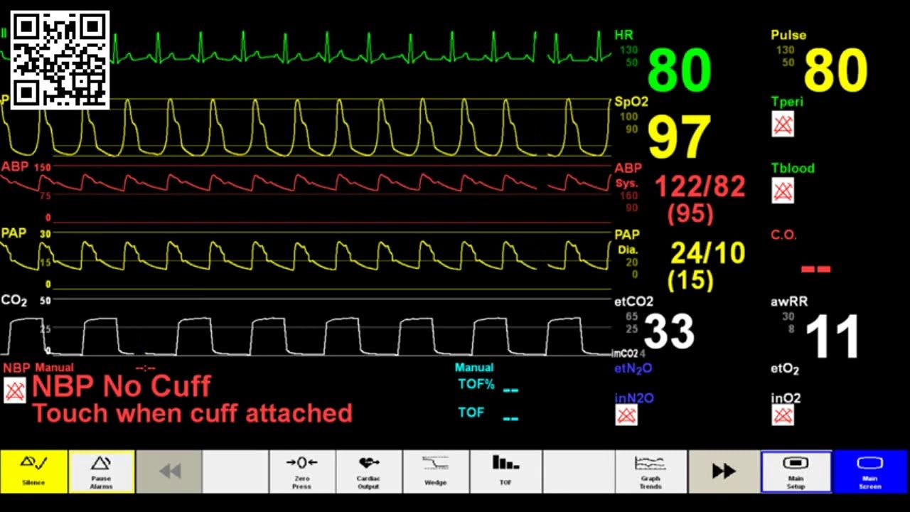 Timed Simulated Patient ICU Monitor - YouTube