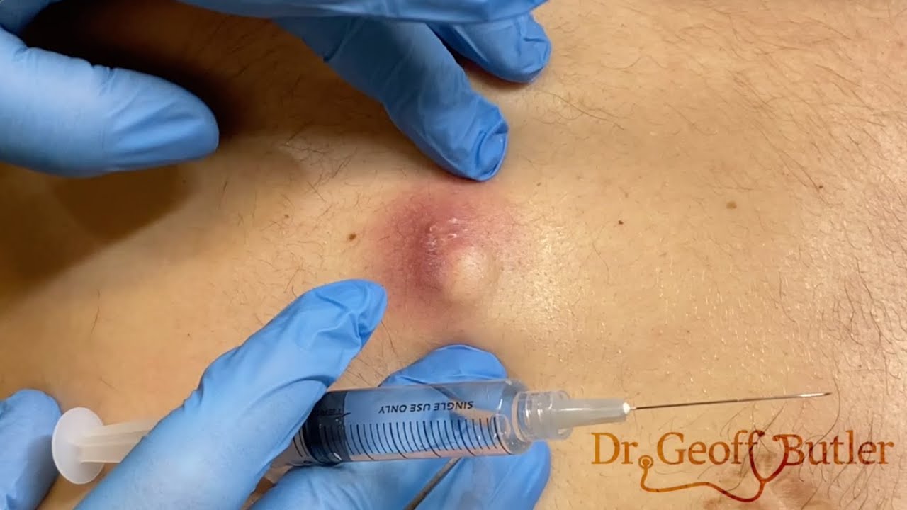 Infected cyst removal from the midback - YouTube