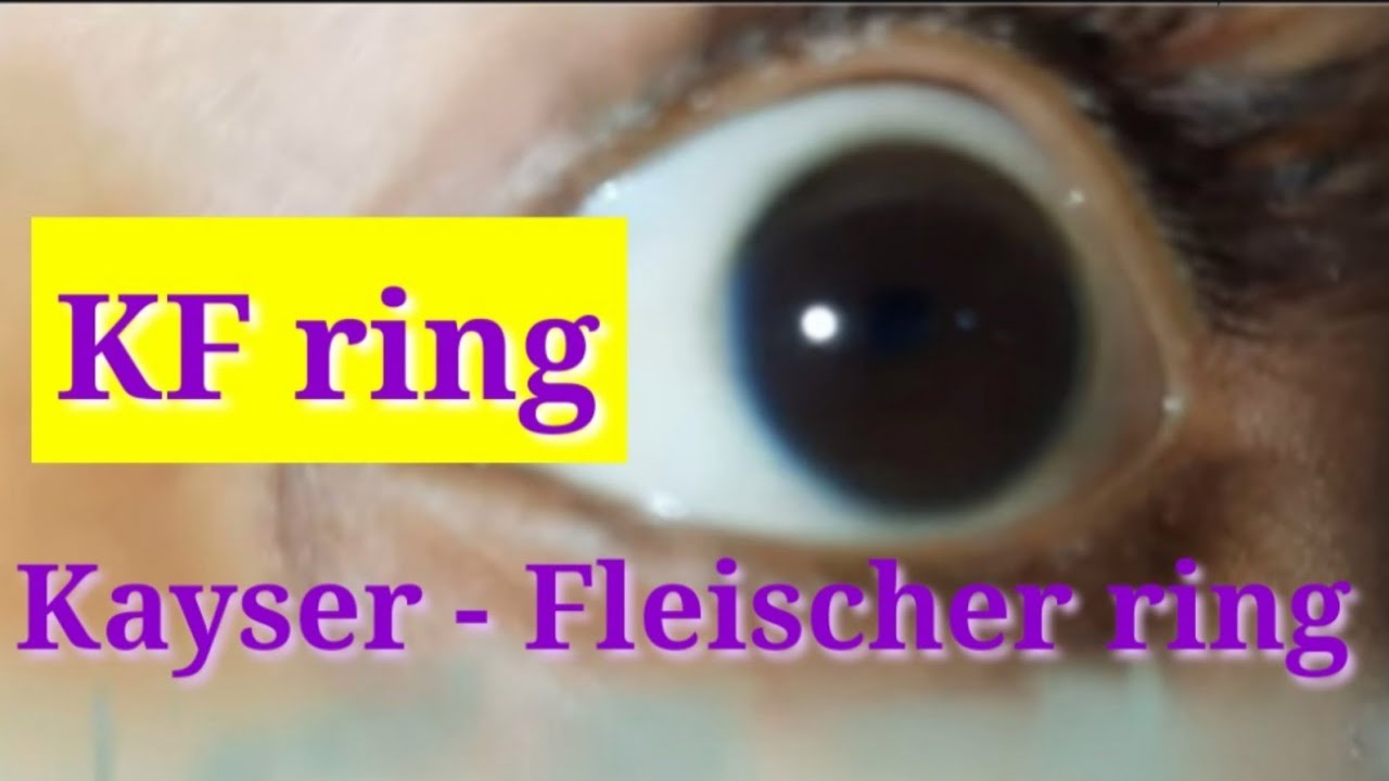 Kayser - Fleischer ring : Wilson's disease - YouTube