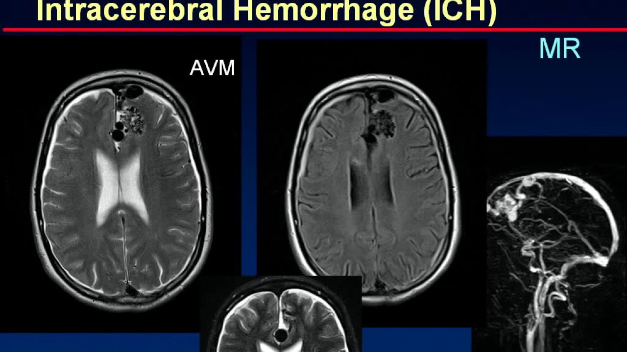 CT BRAIN ACUTE INFARK - YouTube