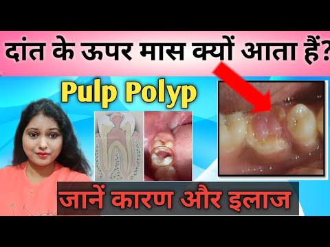 दांत के ऊपर मास क्यों आता हैं? क्या करें? Pulp Polyp cause & treatment ...