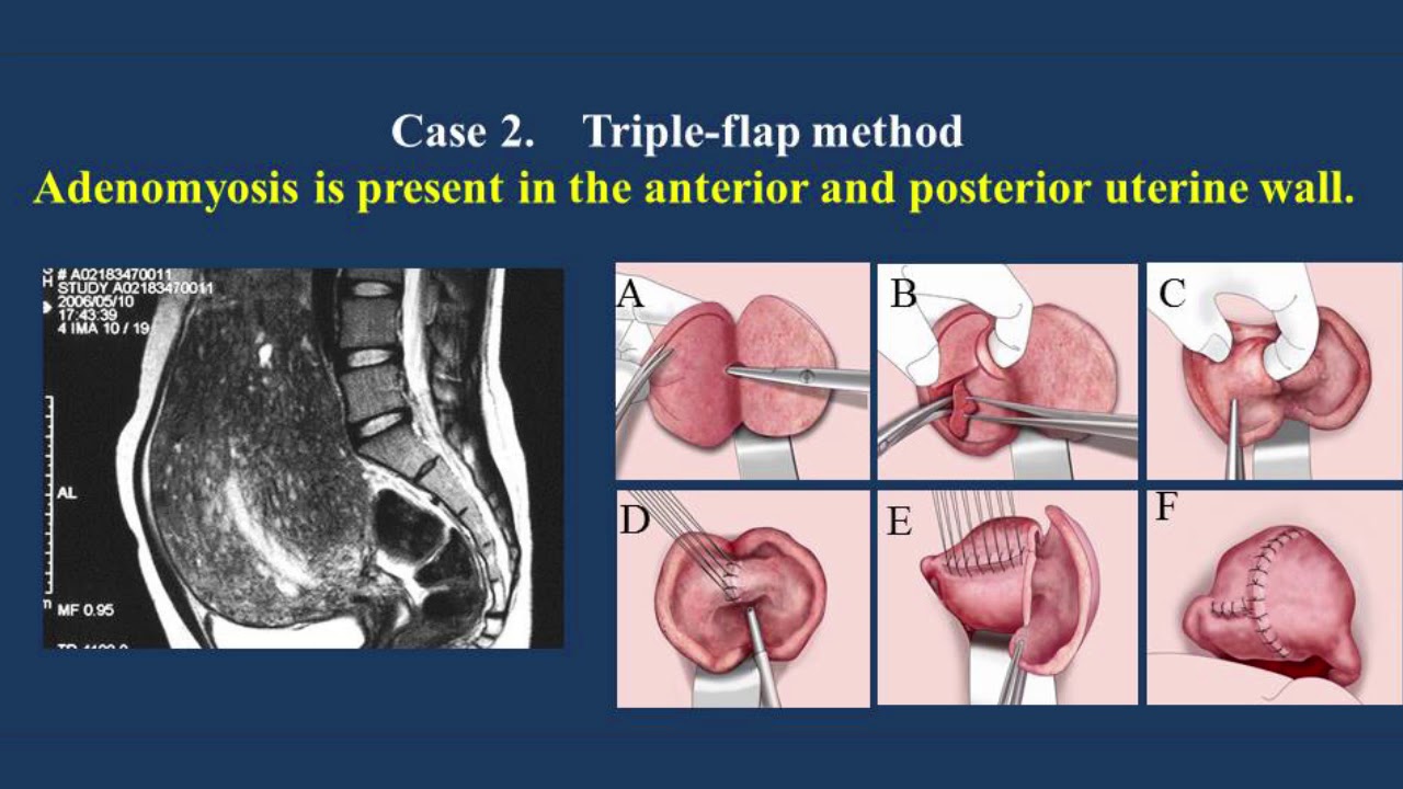 Uterine adenomyosis and adenomyoma: The surgical approach - YouTube