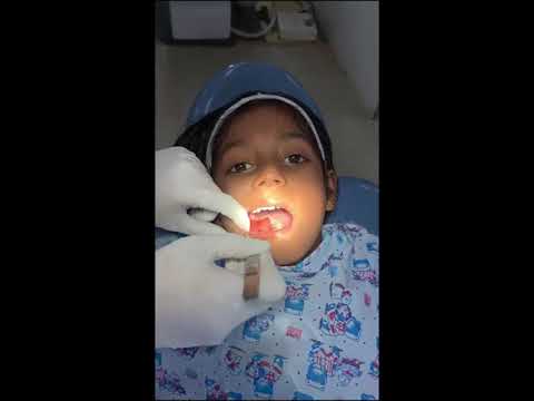 Stainless Steel Crown for Deciduous Tooth