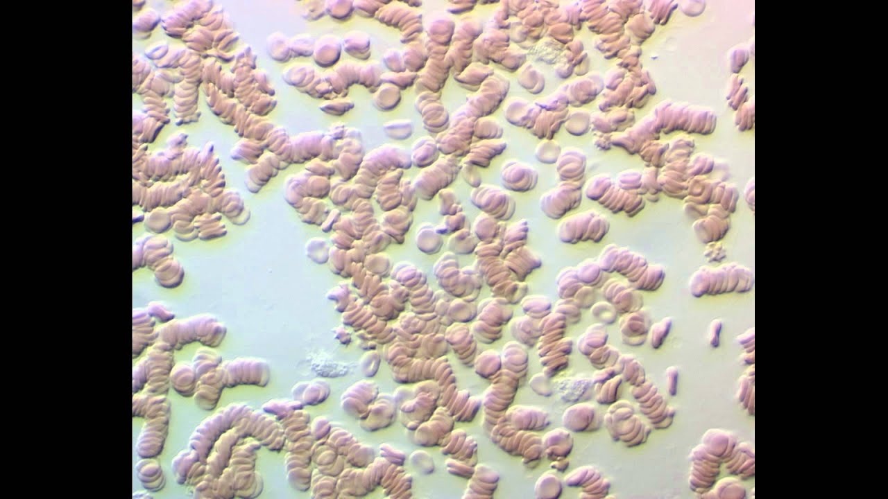 Lyme Disease blood VS "Normal" blood #2 - YouTube