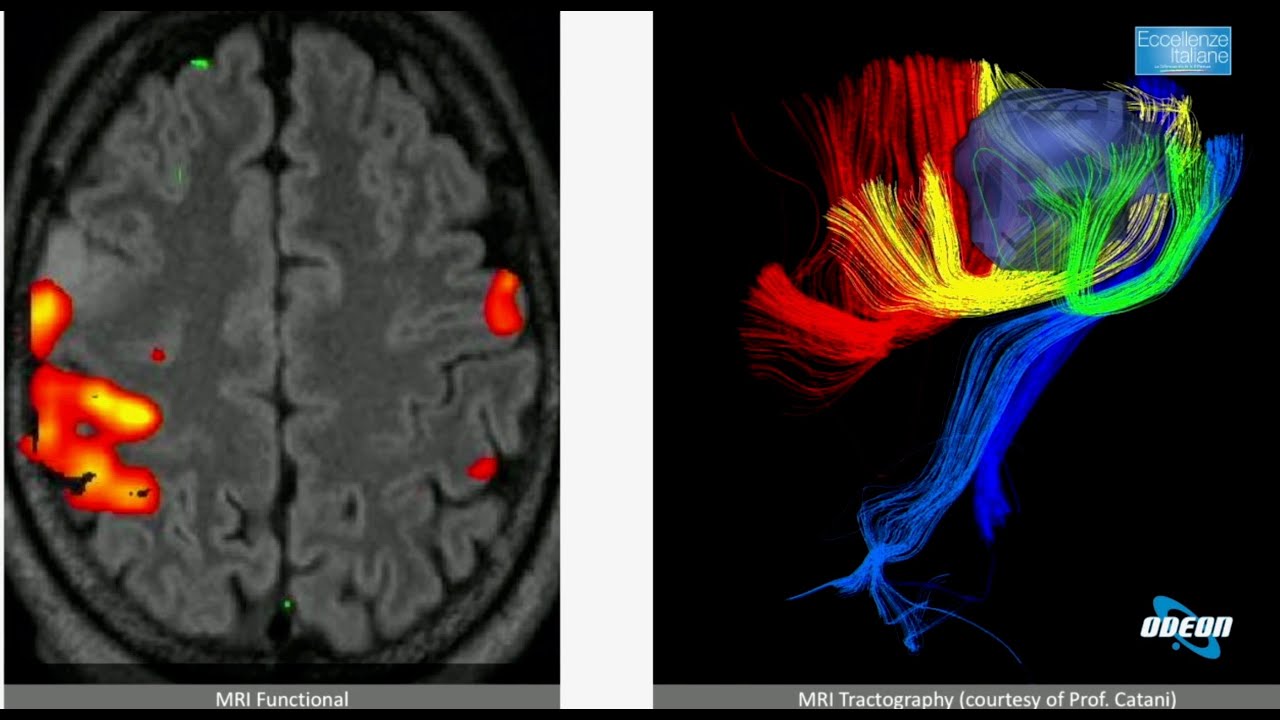Diagnosi dei tumori cerebrali. Intervista al Dott. Christian Brogna ...