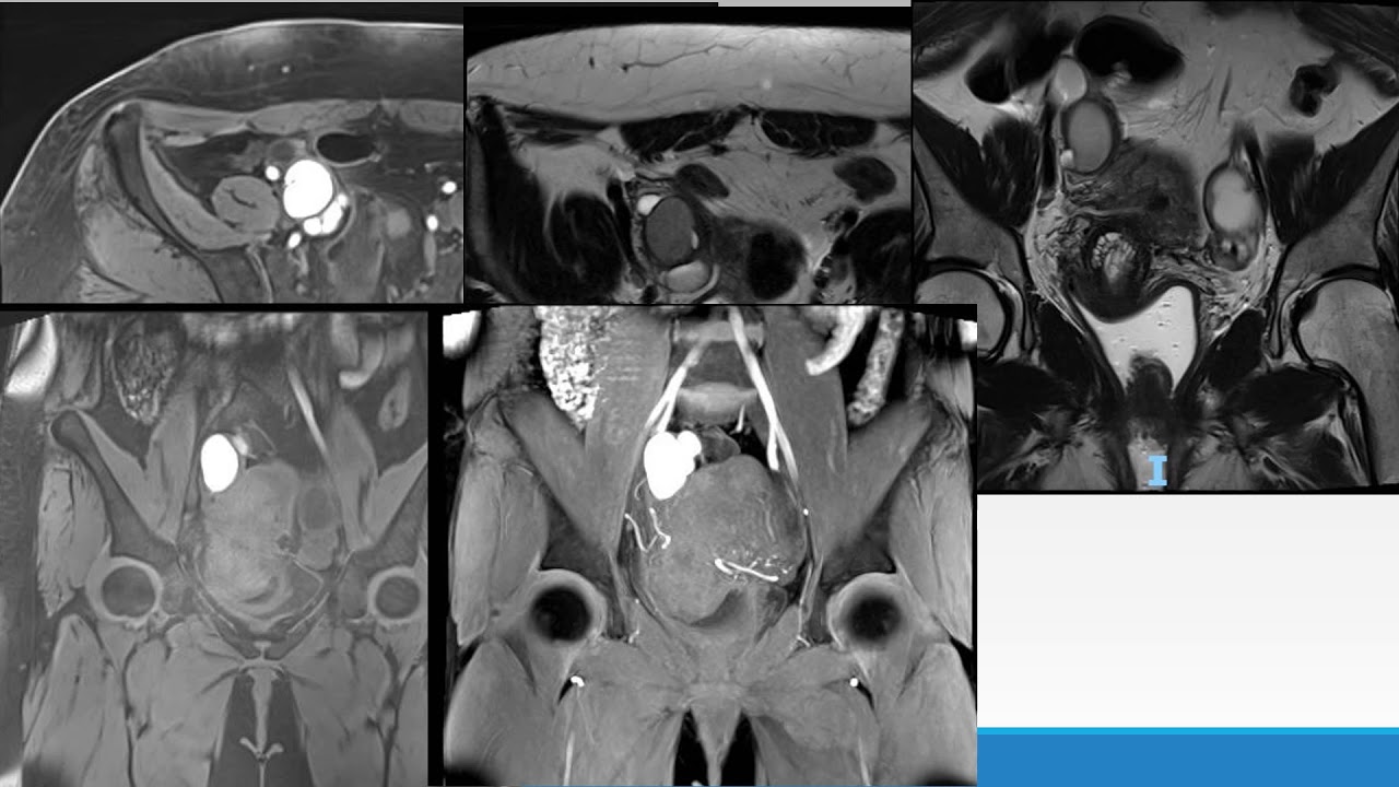 Diagnóstico de Endometriosis por RMN con equipos 3T (Parte 2) - YouTube