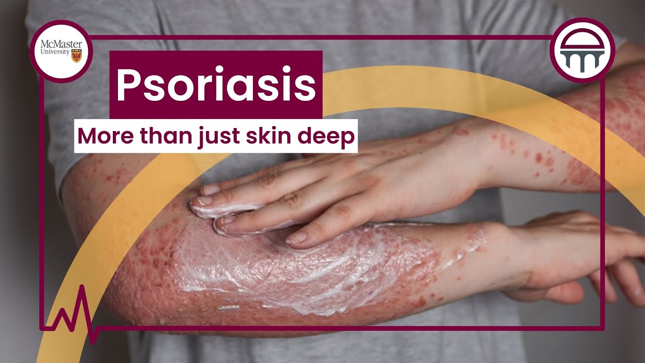 Psoriasis: More than just a rash - YouTube