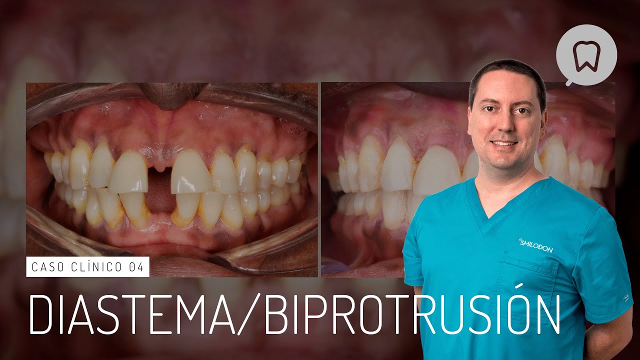 Diastemas y biprotrusión · Caso clínico de ortodoncia - YouTube