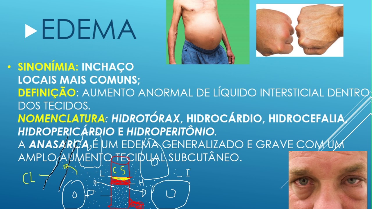 Patologia Geral - Edemas (parte 1) - YouTube