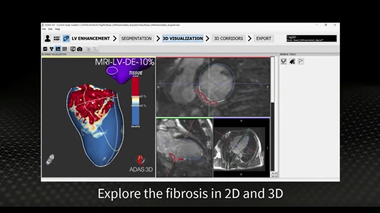 ADAS 3D for the Left Ventricle - YouTube