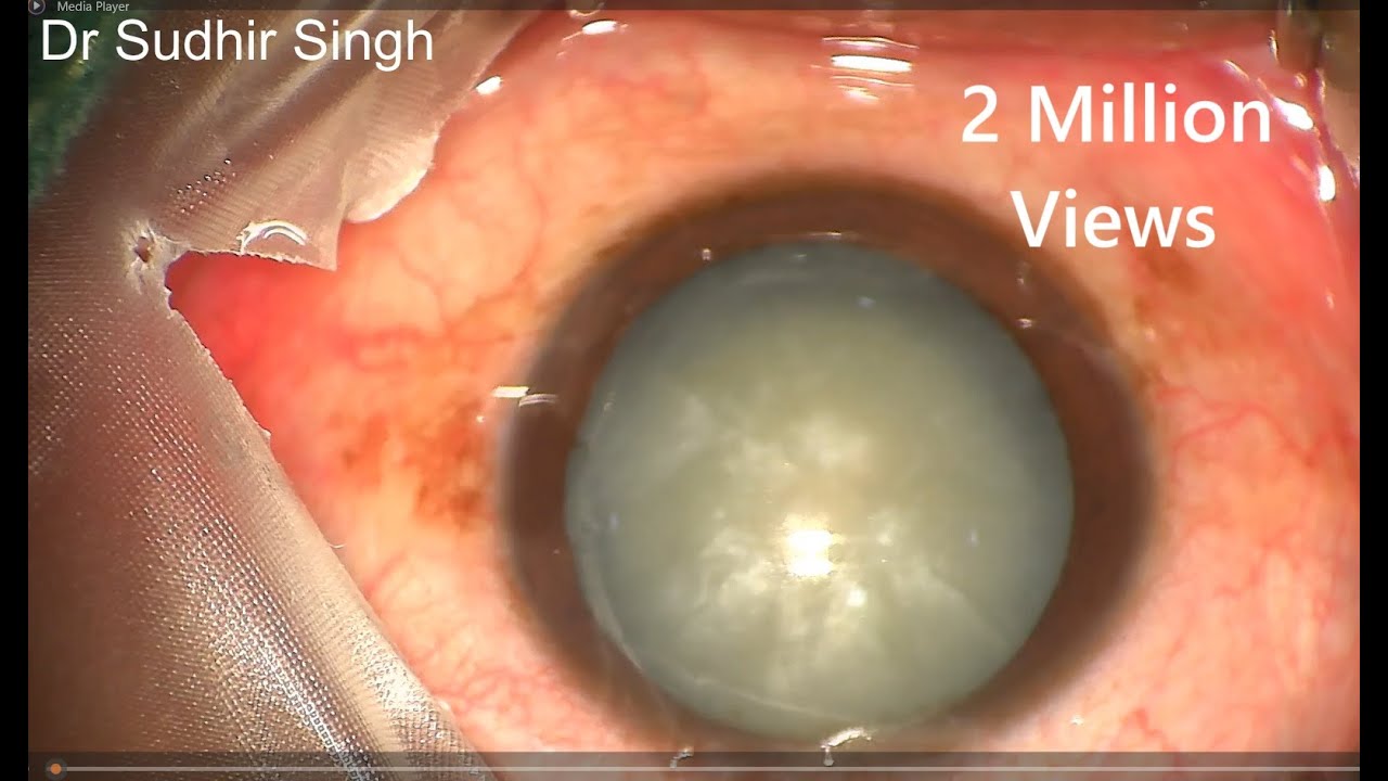 Conquering Intumescent White Cataract in a Young Patient with Advanced ...