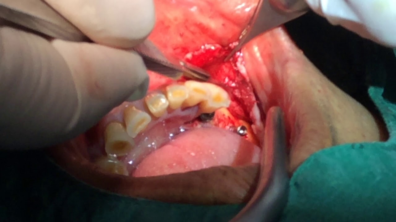 Vertical & Horizontal Ridge Augmentation by DrnarongDental - YouTube