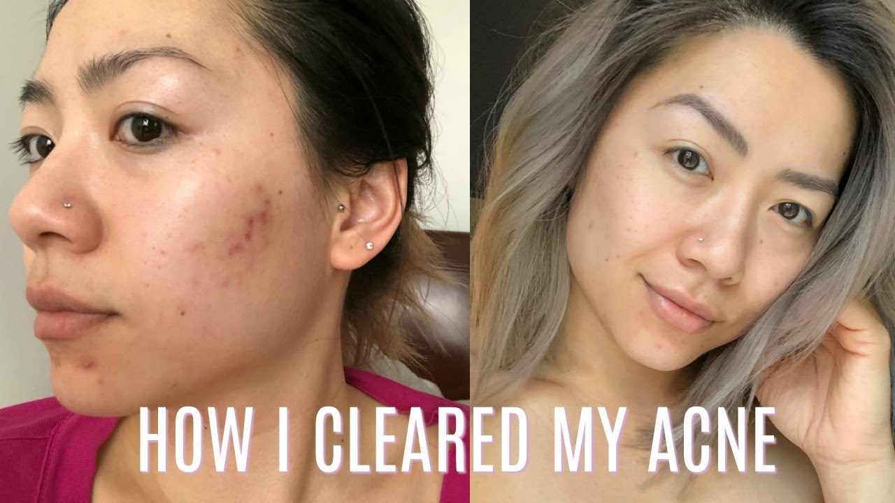 The Skincare Routine That Cleared My Acne And Skin For Good Youtube