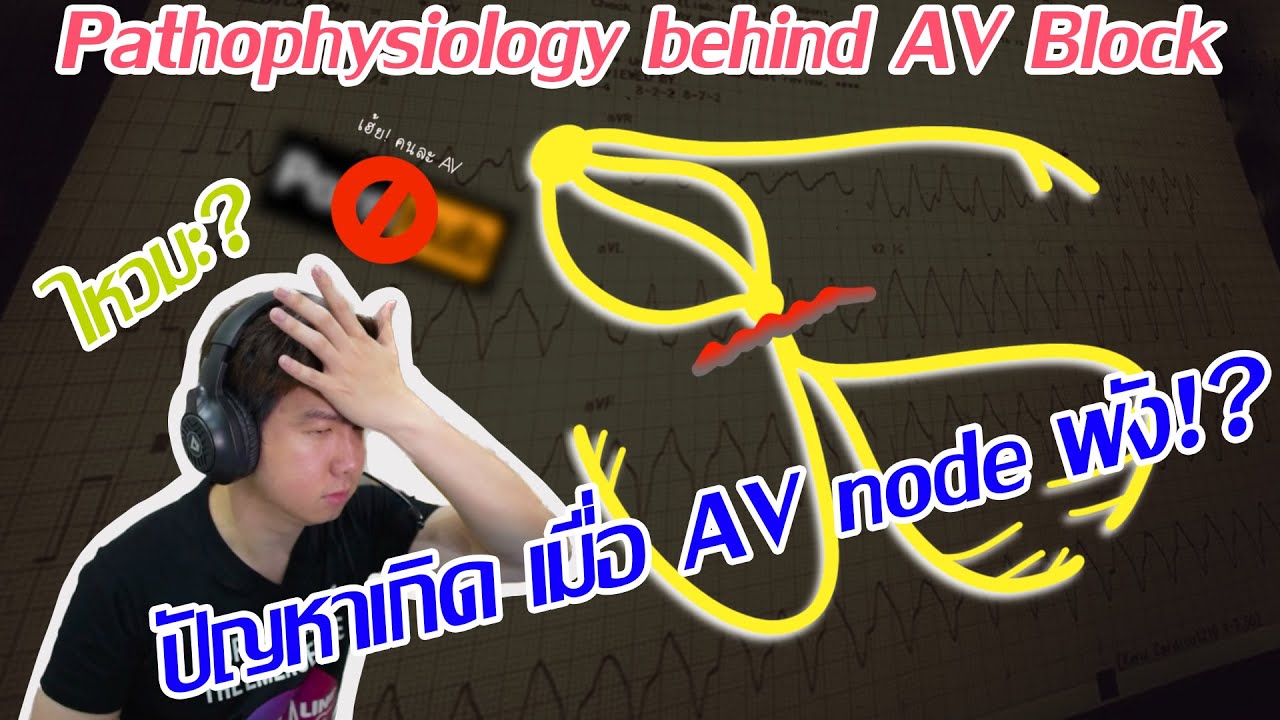 AV Block Pathophysiology AV Block Part 2 4 Frontline av-block-pathophysiology-av-block-part-2-4-frontline