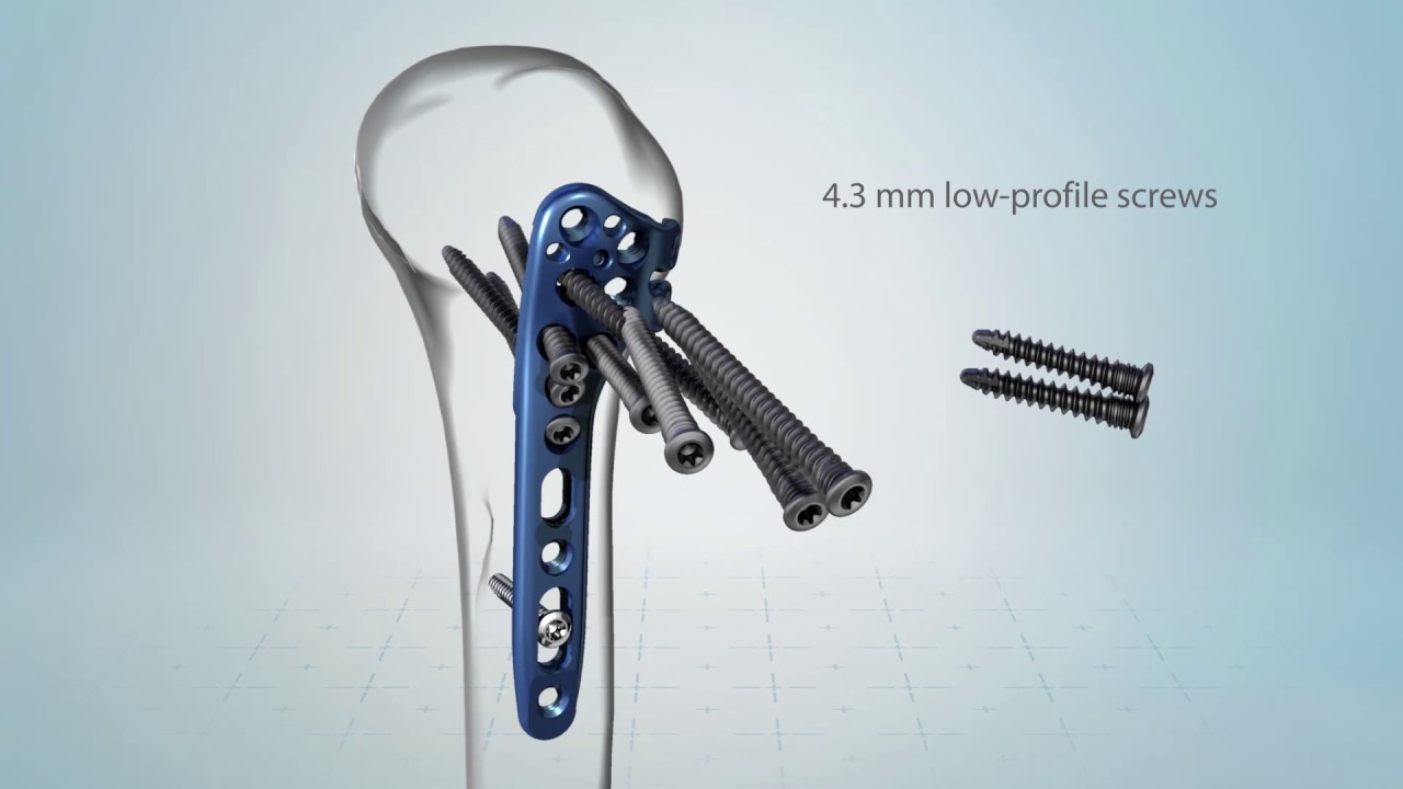 Acumed Proximal Humerus Nail&Plating System "Polarus" - YouTube