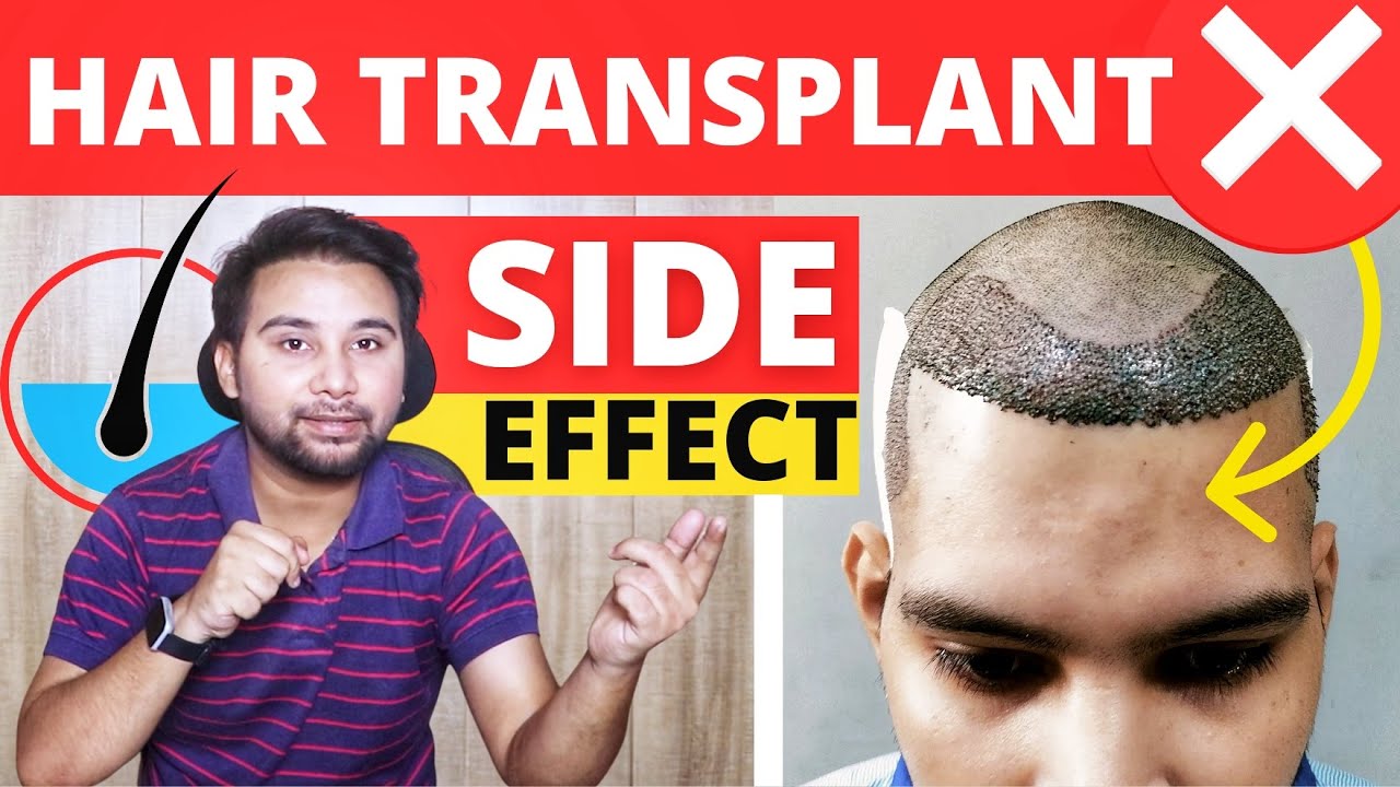 Don't Get A Hair Transplant Before Watching This Video!!! Failed Hair ...