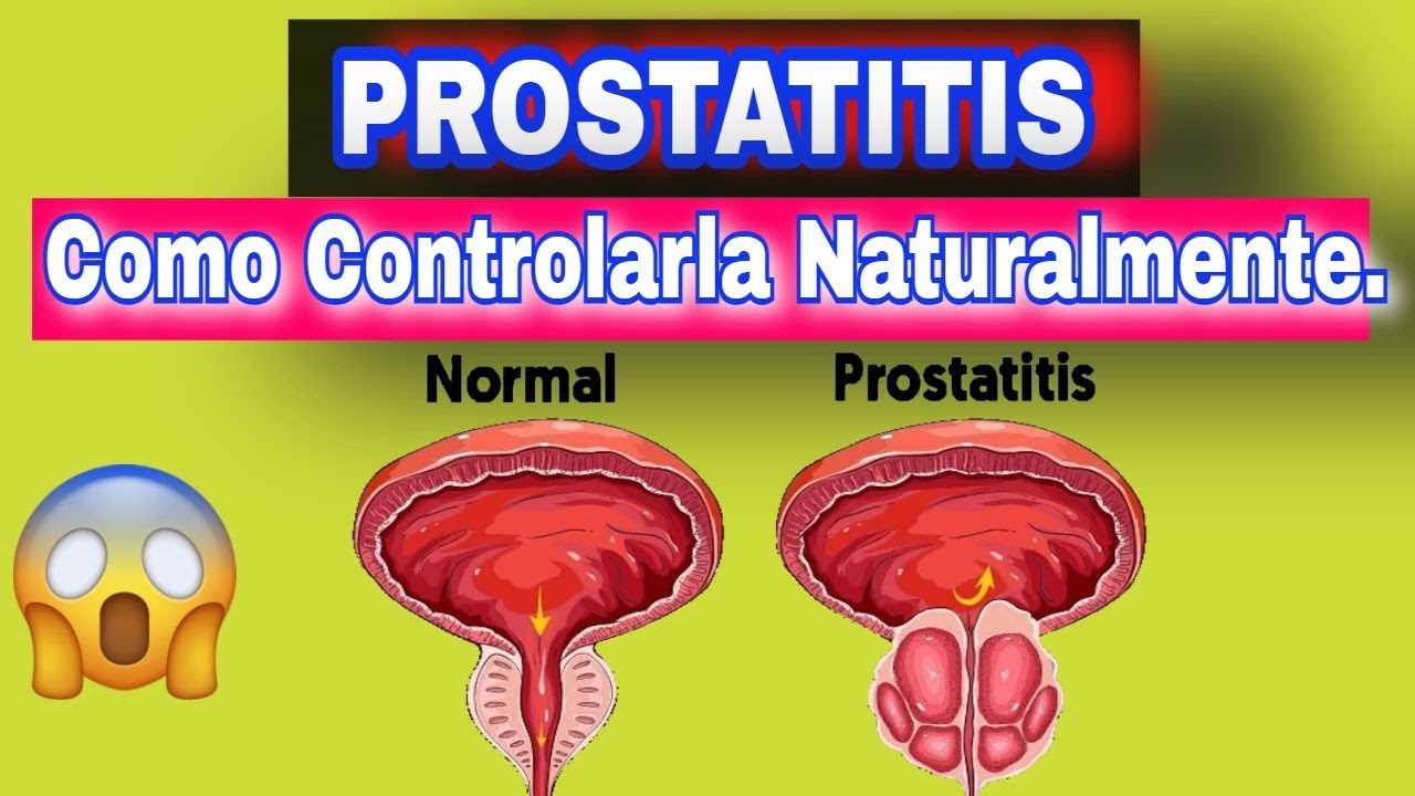 Medicina natural: Cómo mantener una próstata saludable con cambios ...