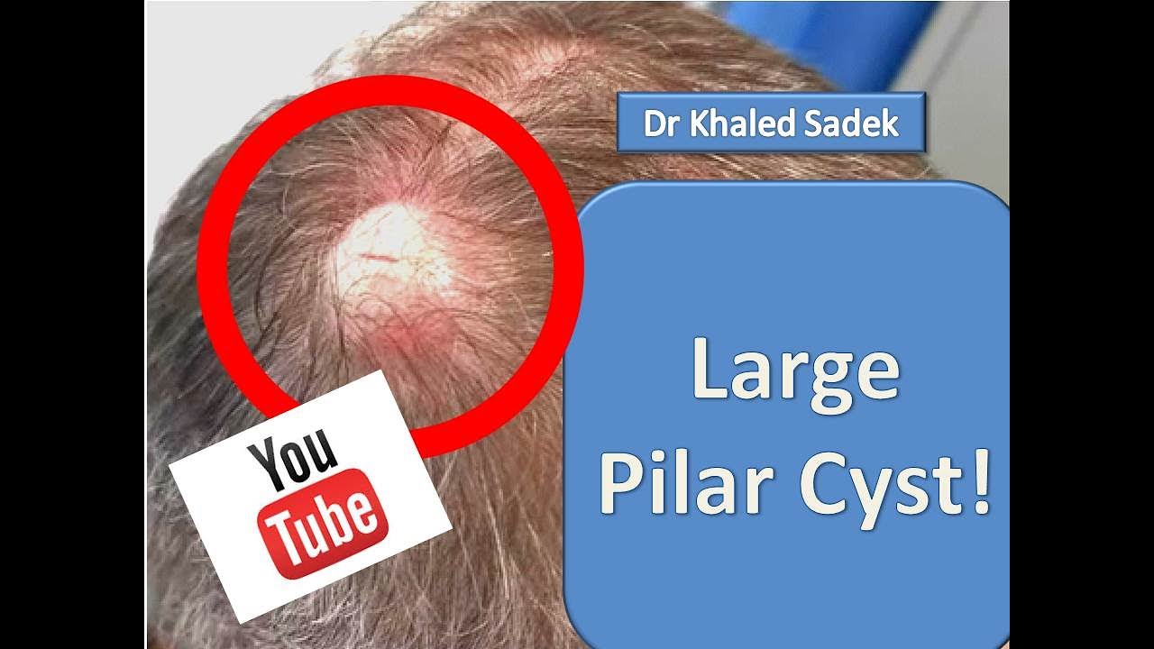Massive Pilar Cyst Removal. Dr Khaled Sadek. LipomaCyst.com - YouTube