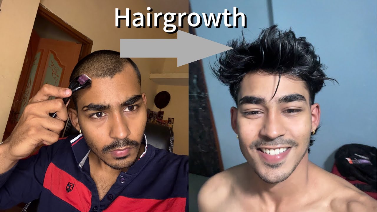 Plan of action to get your hair back..! #hairlinerestoration # ...