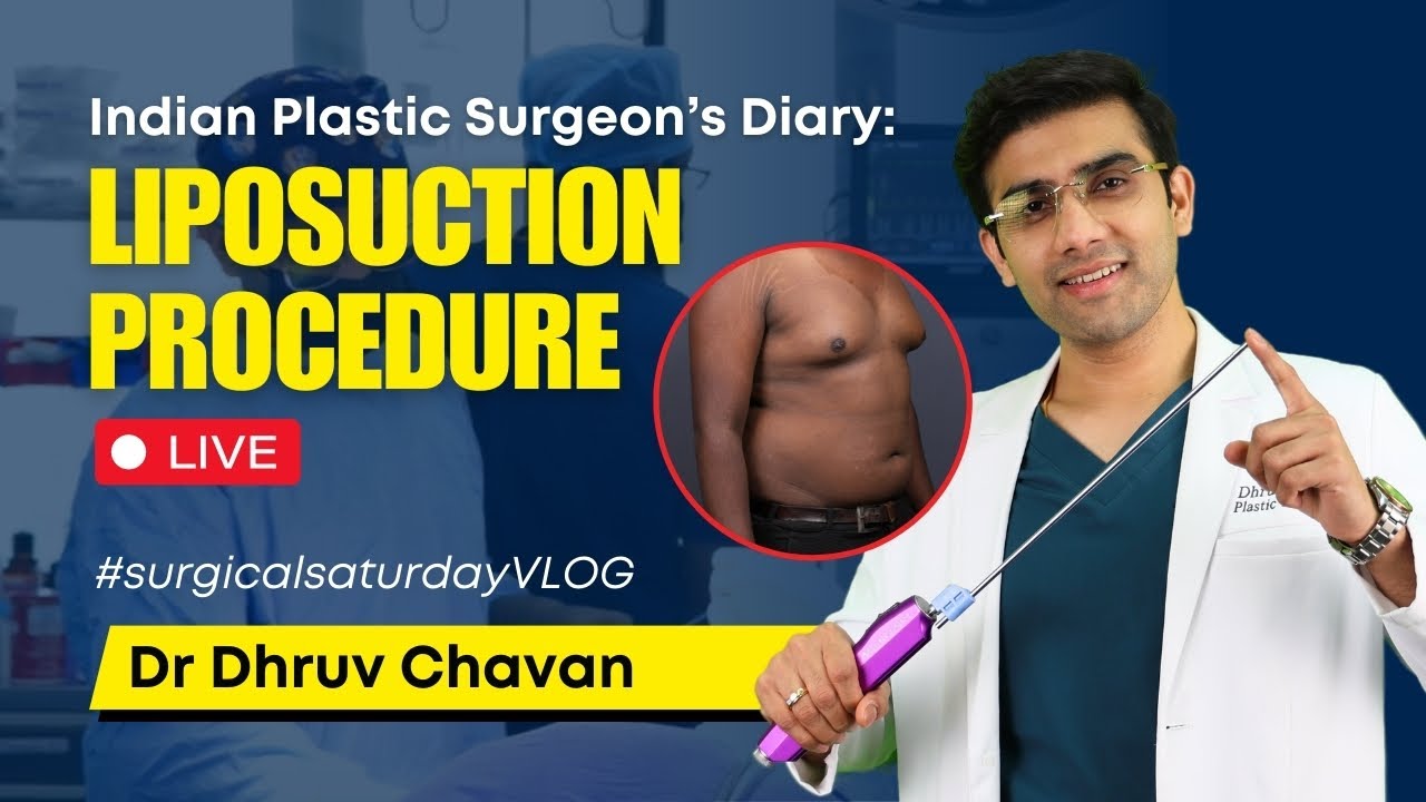 How does Liposuction Work? 🛑 LIVE | Belly Fat Liposuction Procedure ...