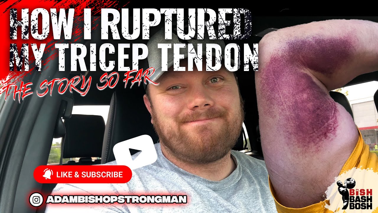 HOW I RUPTURED MY TRICEP TENDON - YouTube