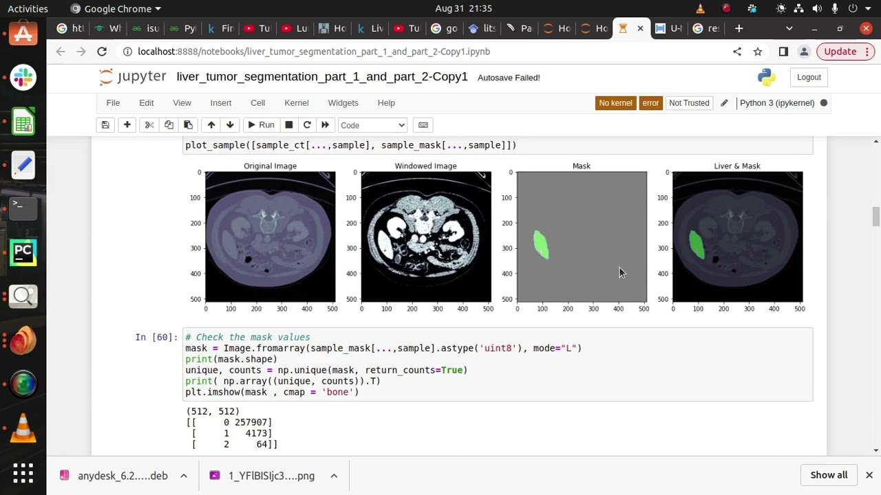 3d Unet Liver Tumor Segmentation And Classification Pytorch Explanation 91 9872993883 For