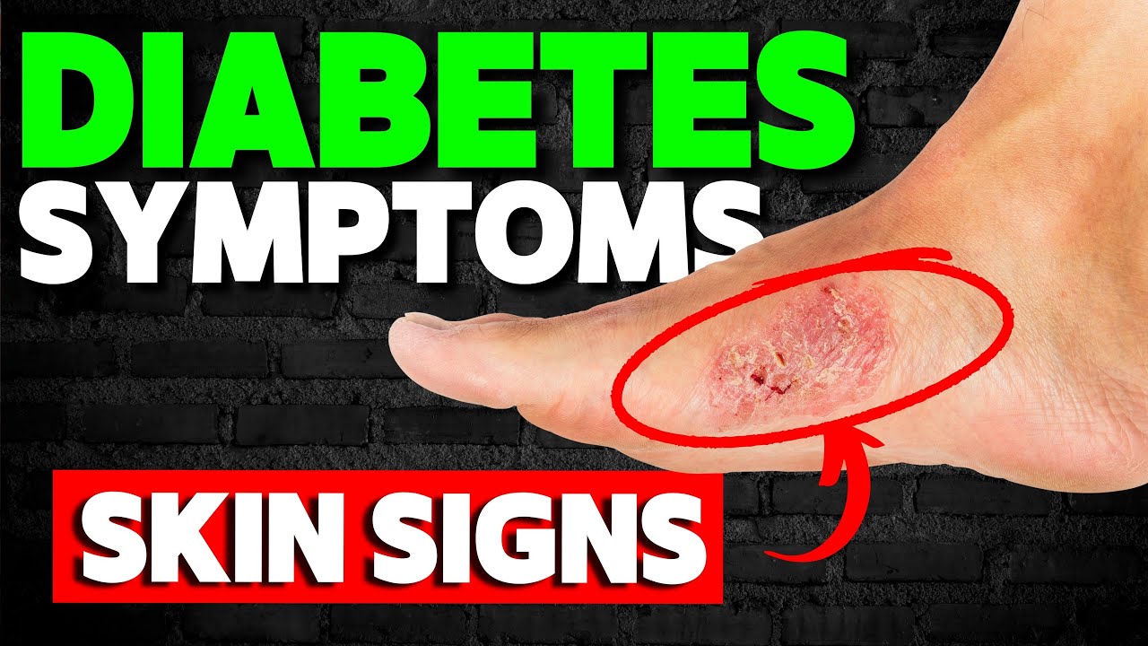 How to Identify Diabetes Through Skin Signs - YouTube