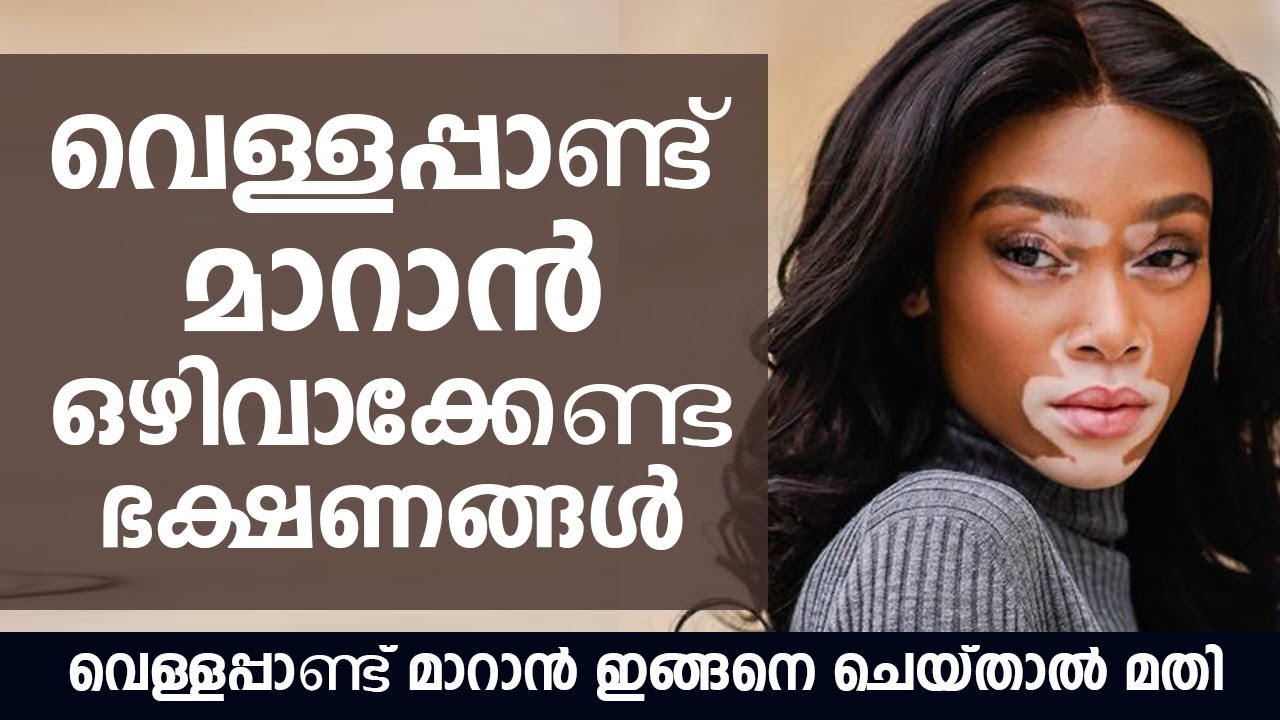 വെള്ളപ്പാണ്ട് മാറാൻ ഇങ്ങനെ ചെയ്താൽ മതി | Vitiligo Treatment Malayalam ...