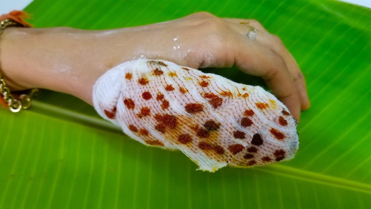 We are cleaning ticks on human hand #402 - YouTube