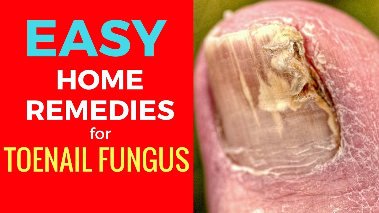 Easy Home Remedies for Toenail Fungus - How to Get Rid of Toenail ...