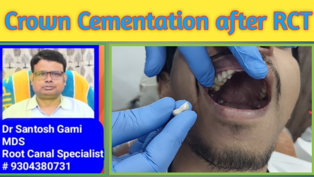 Crown Cementation after RCT l Cap Cementation l Crown। Cap । - YouTube