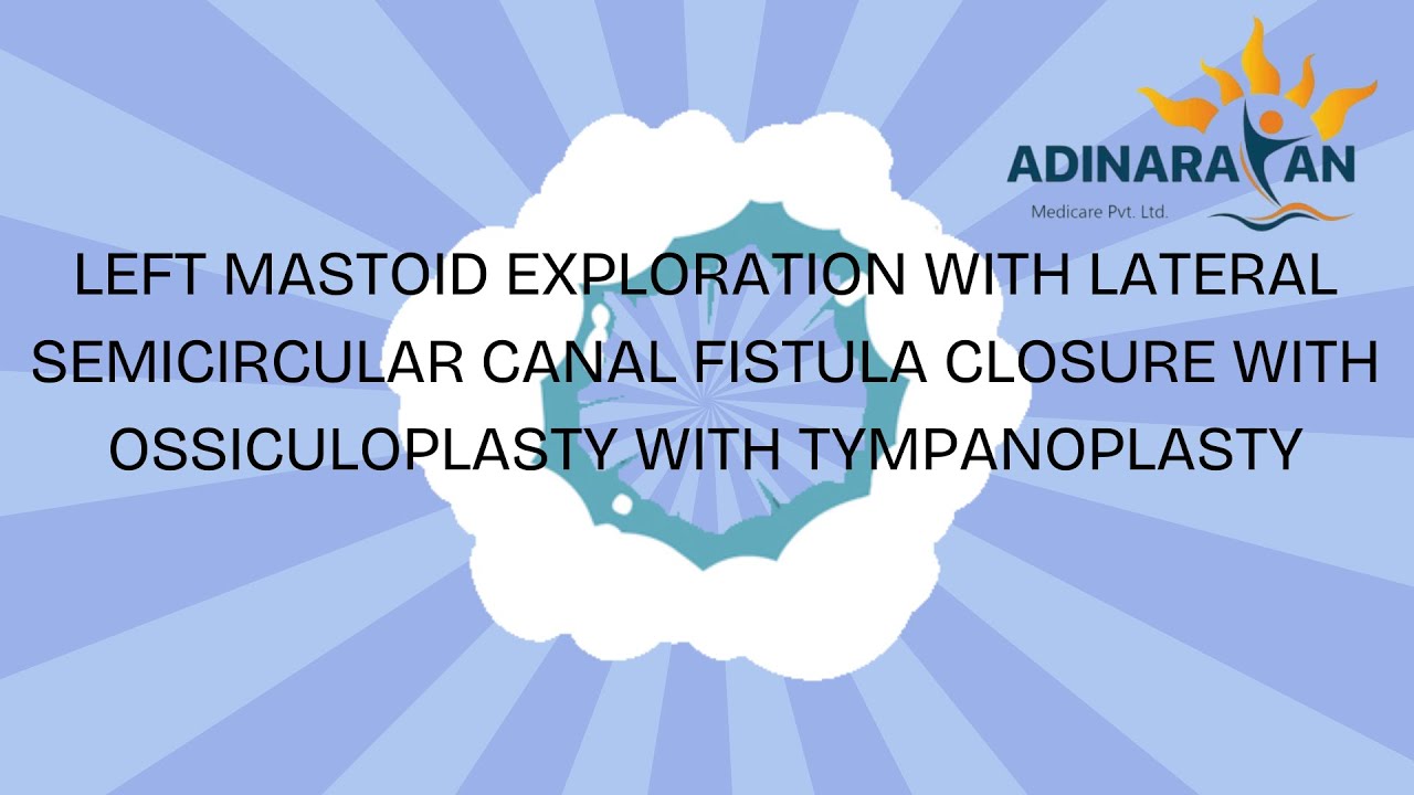 LT Mastoid Exploration, Lateral Semicircular Canal Fistula Closure ...