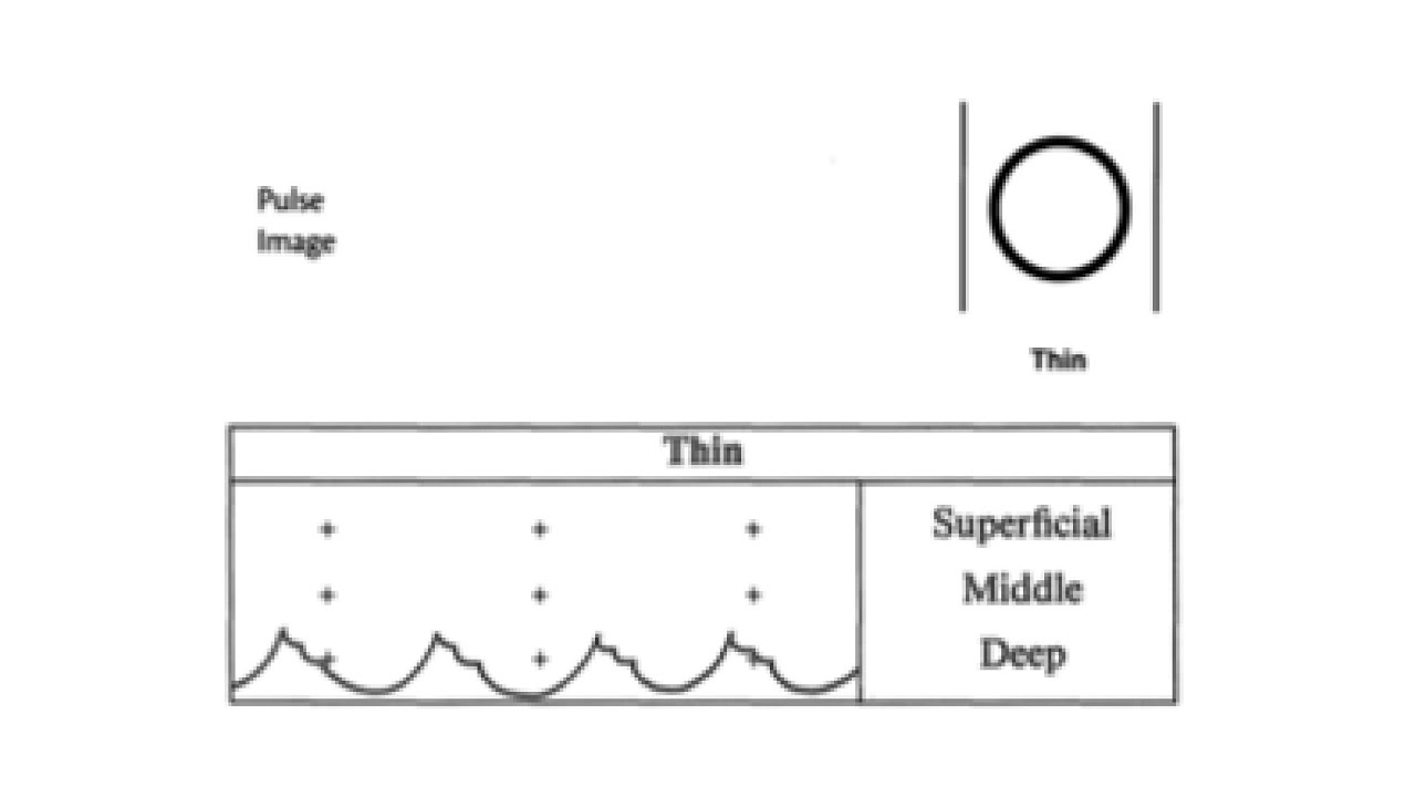 CLINICAL SIGNIFICANCE OF THREADY PULSE (FINE, THIN, SMALL, XI MAI ...
