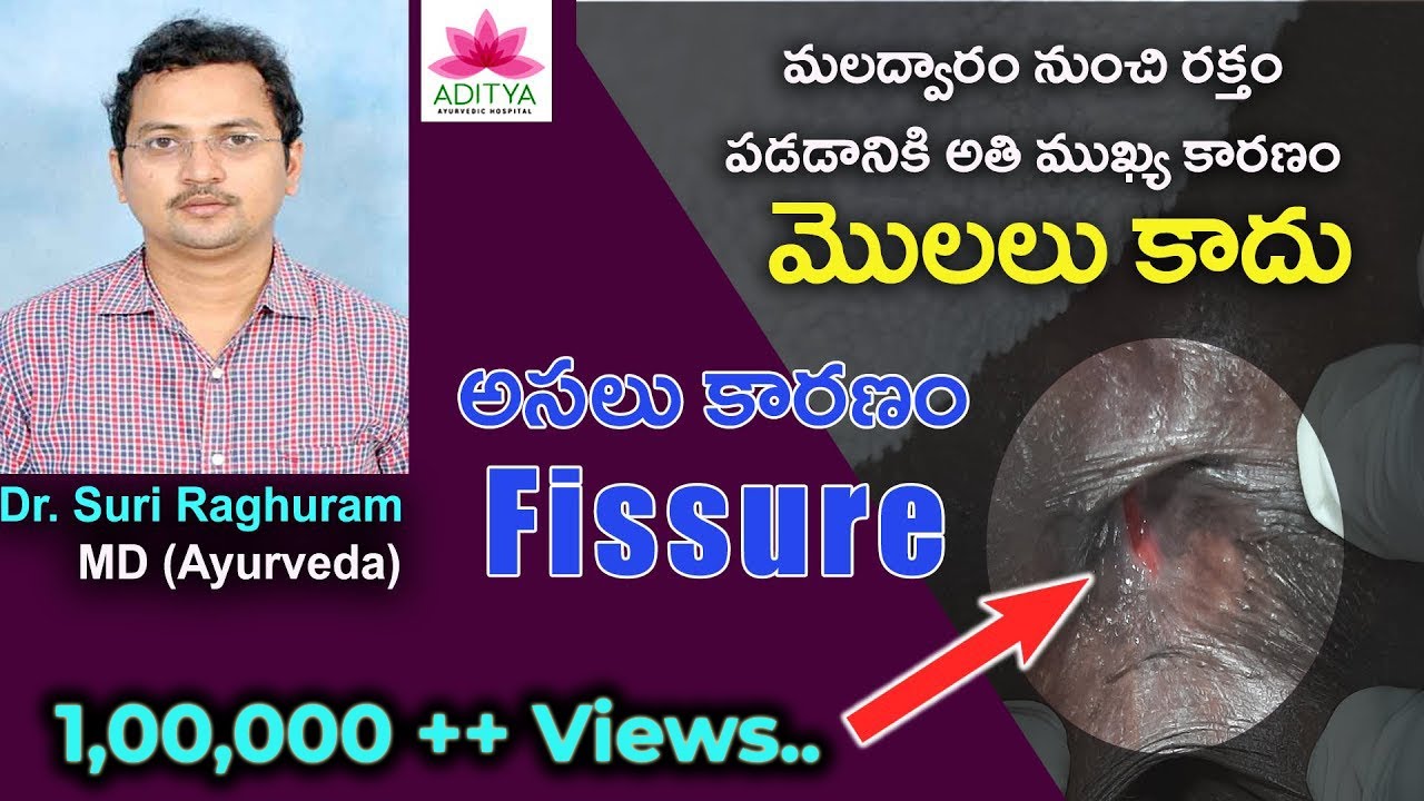 Anal Fissure How To Cure With Ayurveda Best Medicines And Treatment