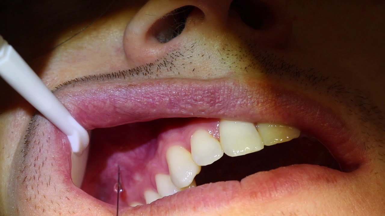 MSA Injection - YouTube