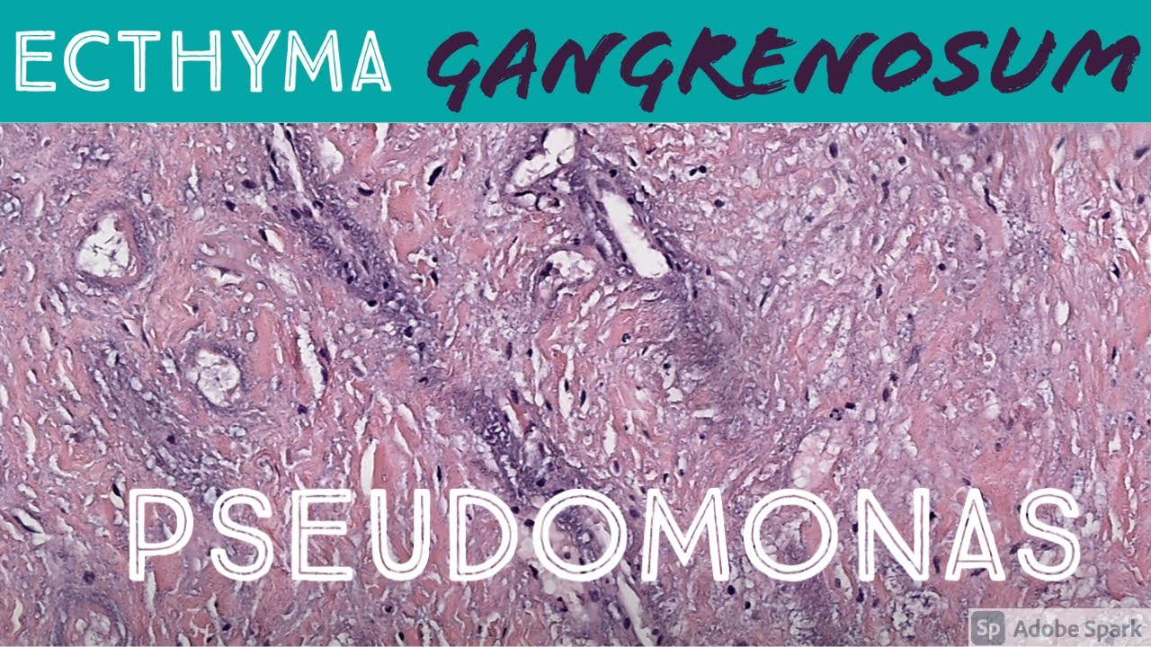 Ecthyma Gangrenosum (Pseudomonas aeruginosa) 5-Minute Pathology Pearls ...