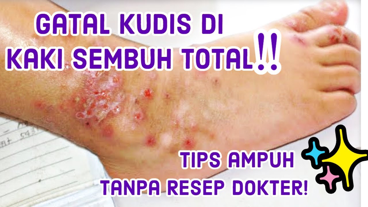CARA MENGATASI GATAL GATAL KUDIS DI KAKI, 100% TANPA RESEP DOKTER ...