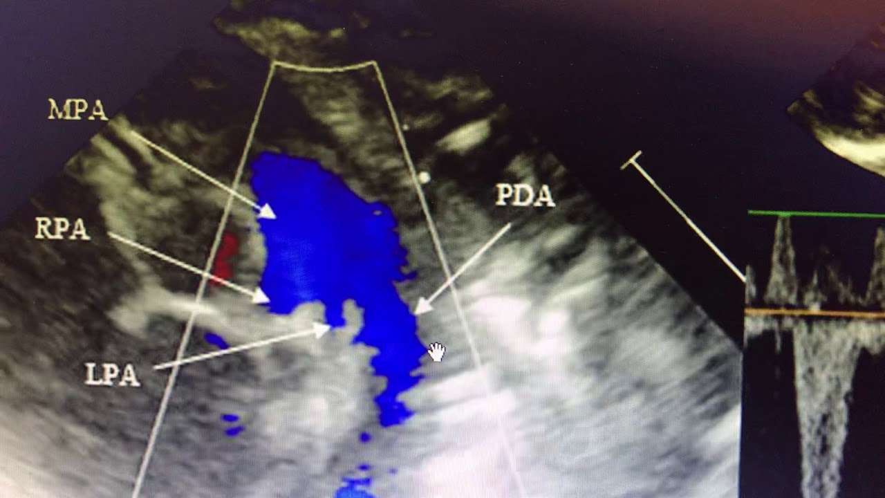 PDA with right to left shunt - YouTube